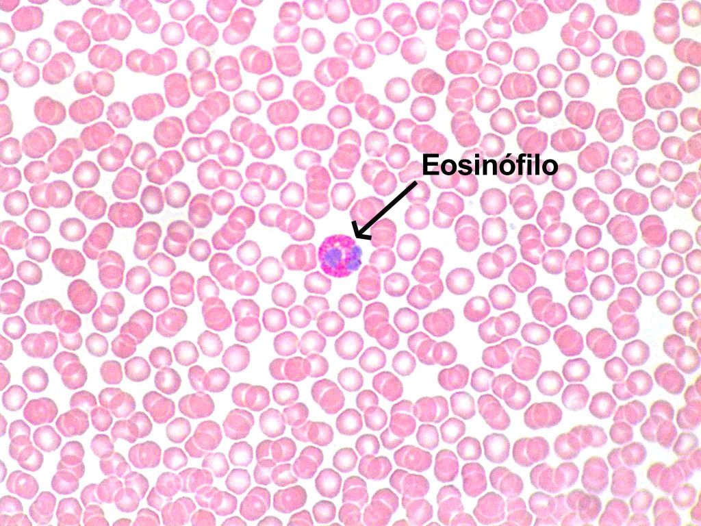 Cuál es el trabajo de los eosinófilos en el organismo - Revista PEM